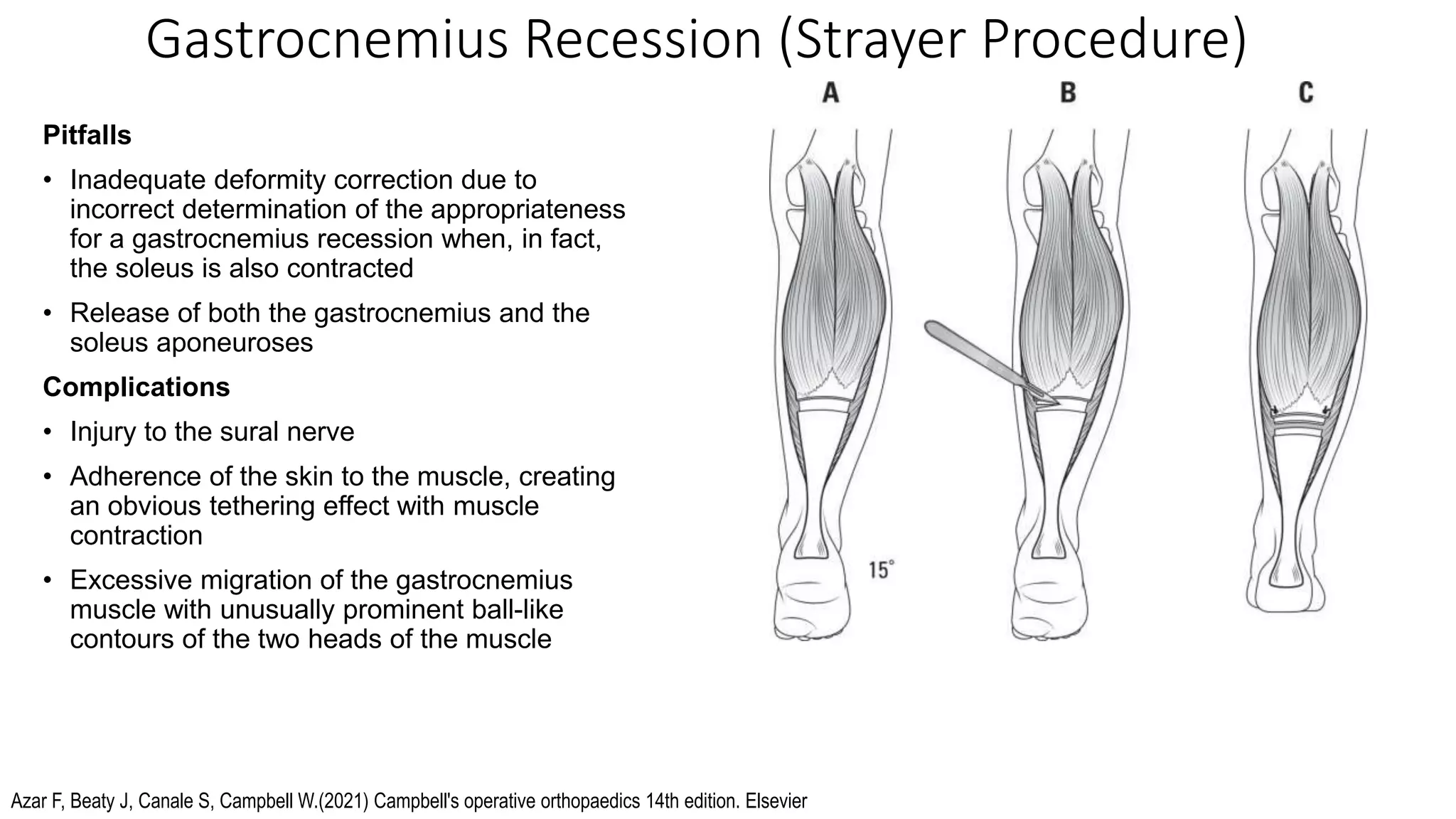 Achilles Tendon Lengthening.pptx