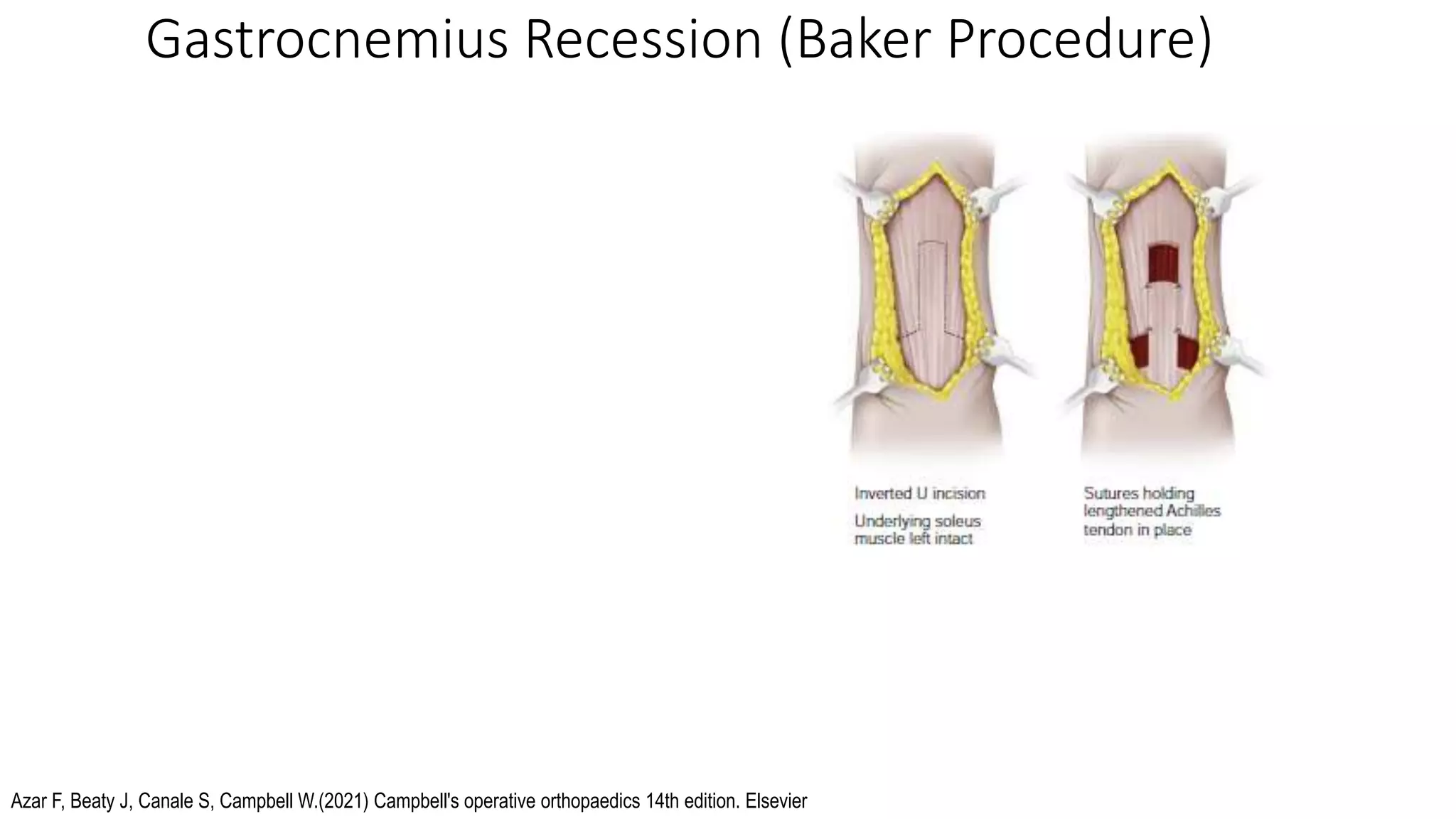 Achilles Tendon Lengthening.pptx