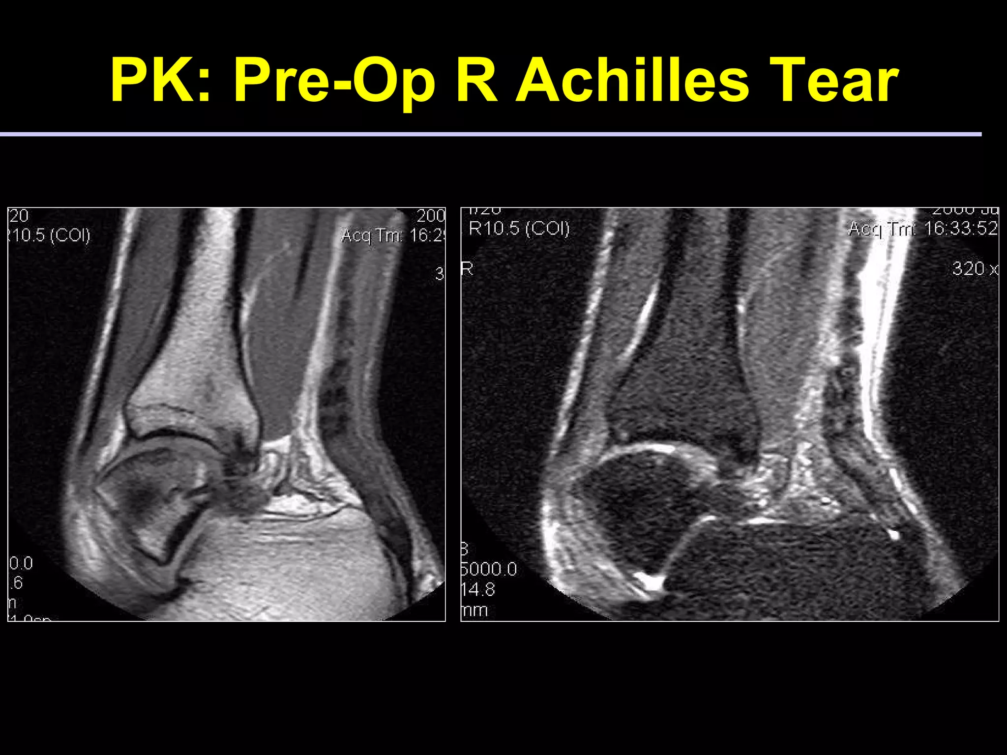 Achilles tendon repair | PPT