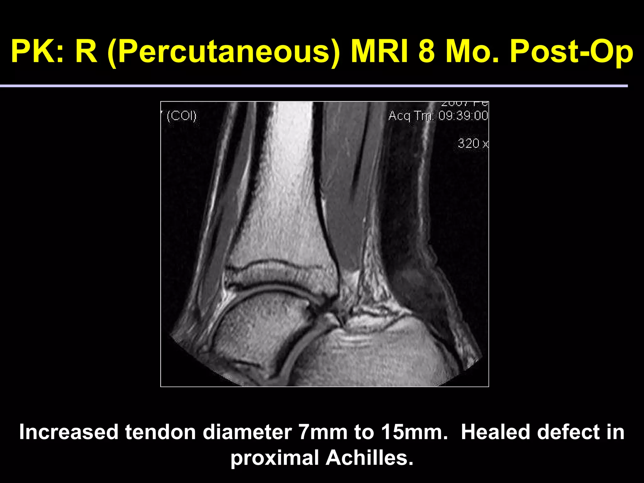 Achilles tendon repair | PPT