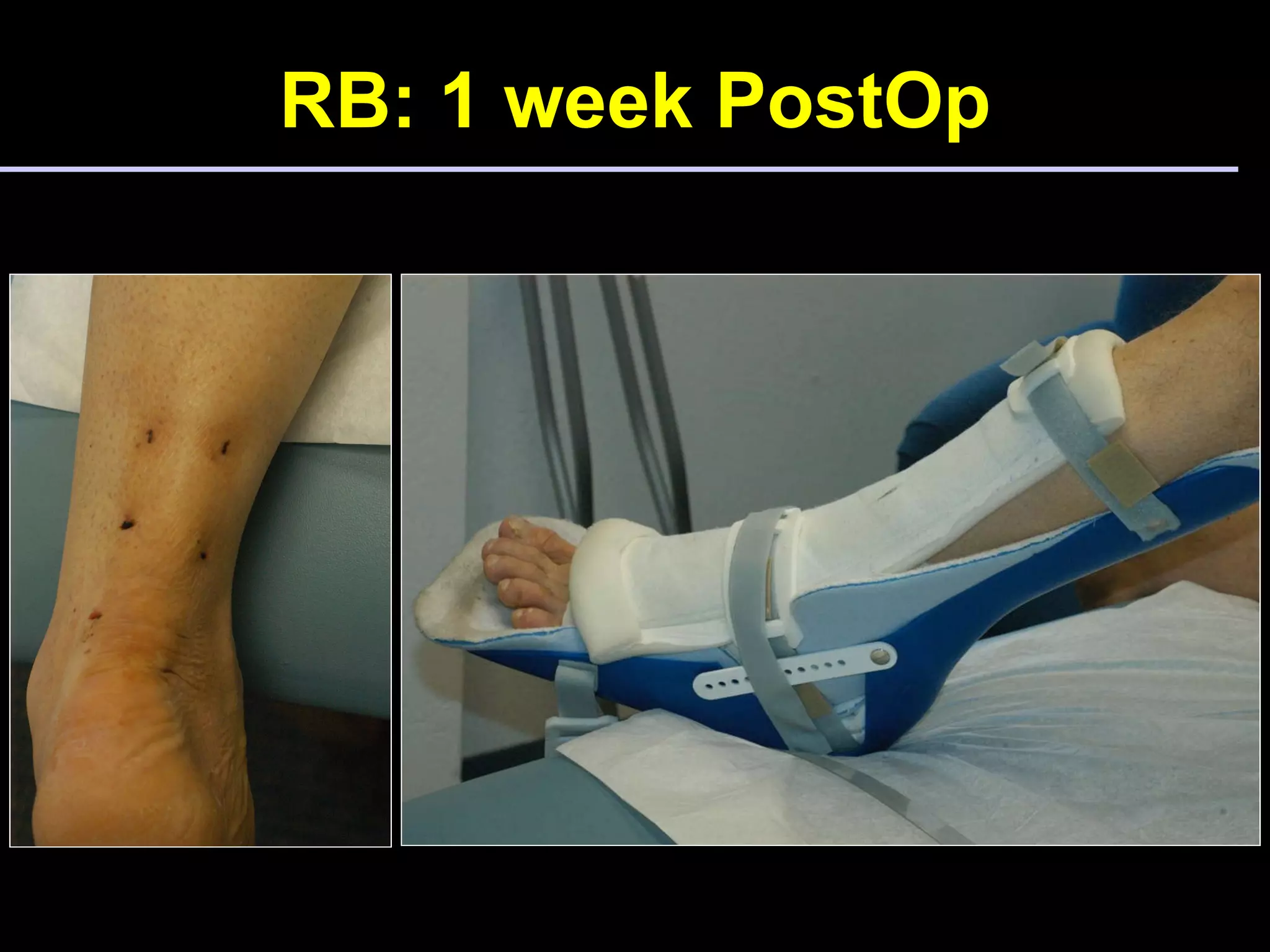Achilles tendon repair | PPT