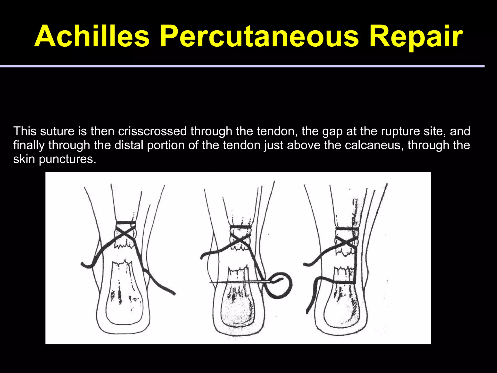 Achilles tendon repair | PPT