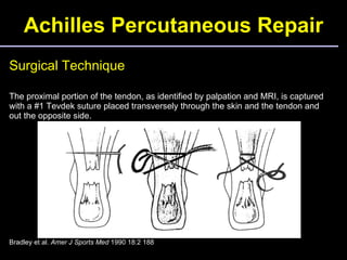 Achilles tendon repair | PPT
