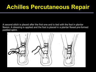 Achilles tendon repair | PPT