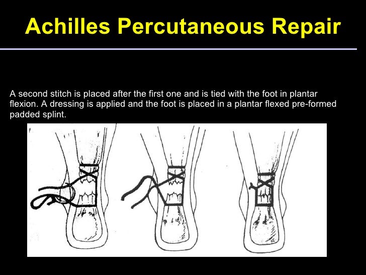 Achilles tendon repair