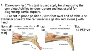 ACHILLES TENDON RUPTURE.pdf