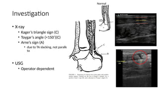 Achilles tendon rupture treatment management | PPTX