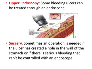 Achlorhydria and peptic ulcer | PPTX