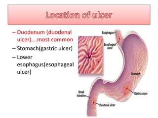 Achlorhydria and peptic ulcer | PPTX