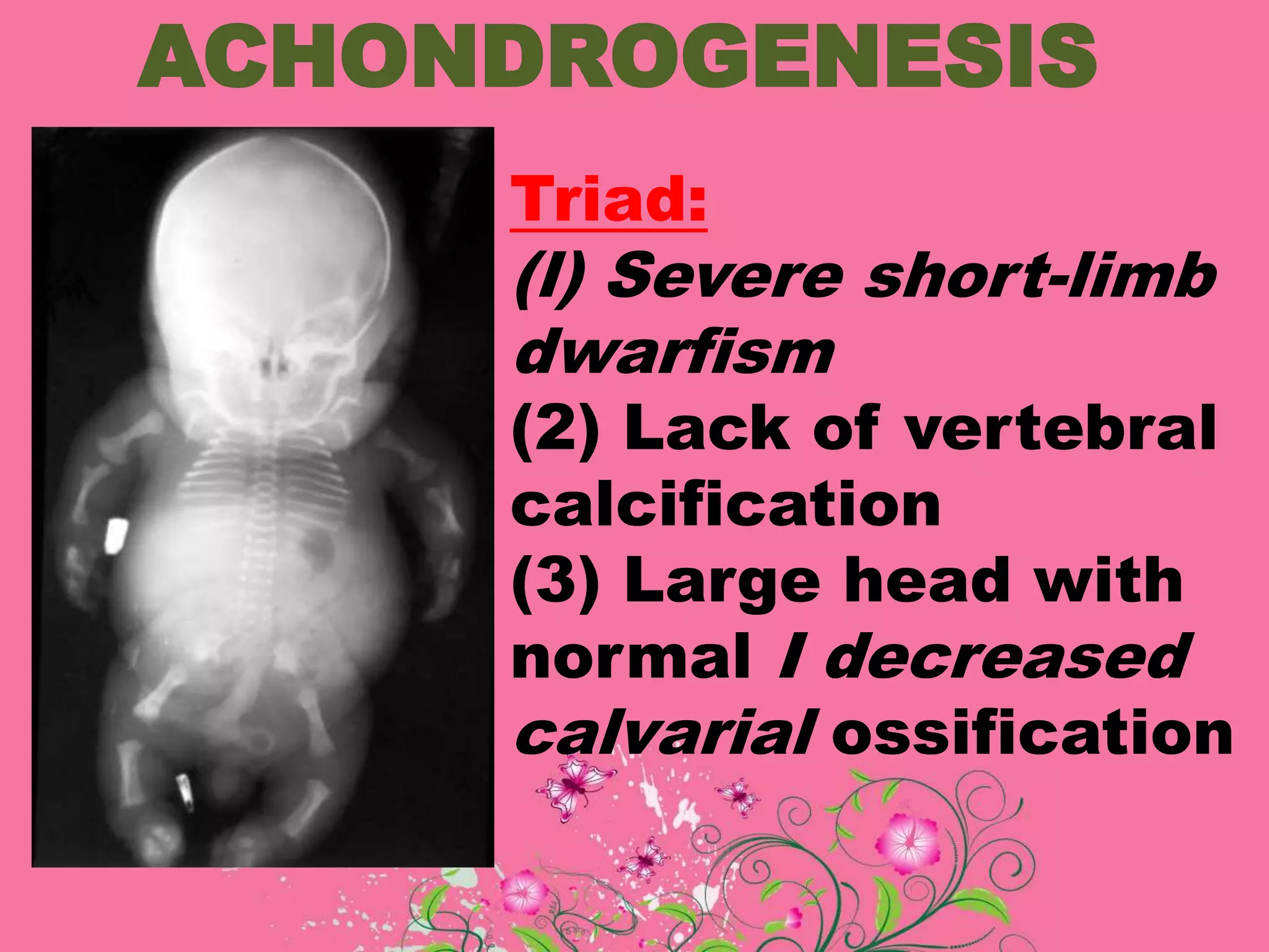 Achondrogenesis | PPTX