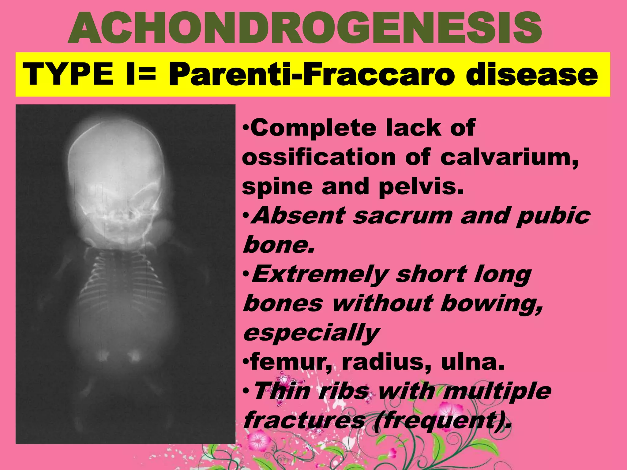 Achondrogenesis | PPTX