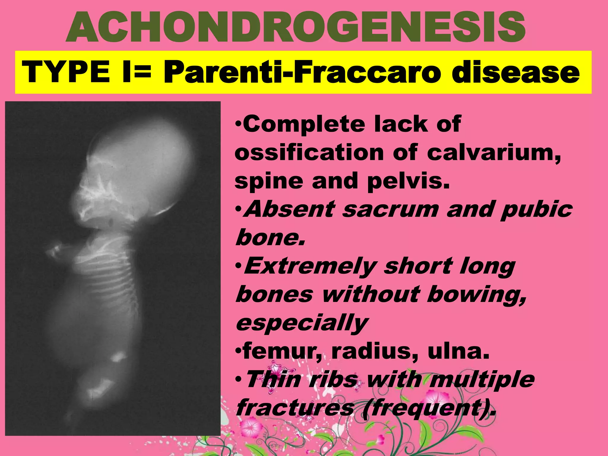 Achondrogenesis | PPTX