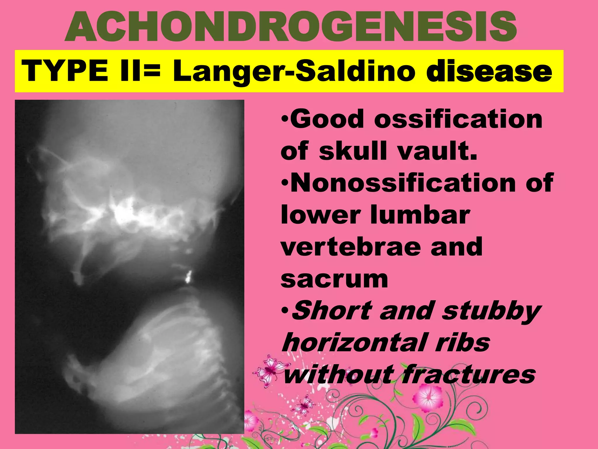 Achondrogenesis | PPTX
