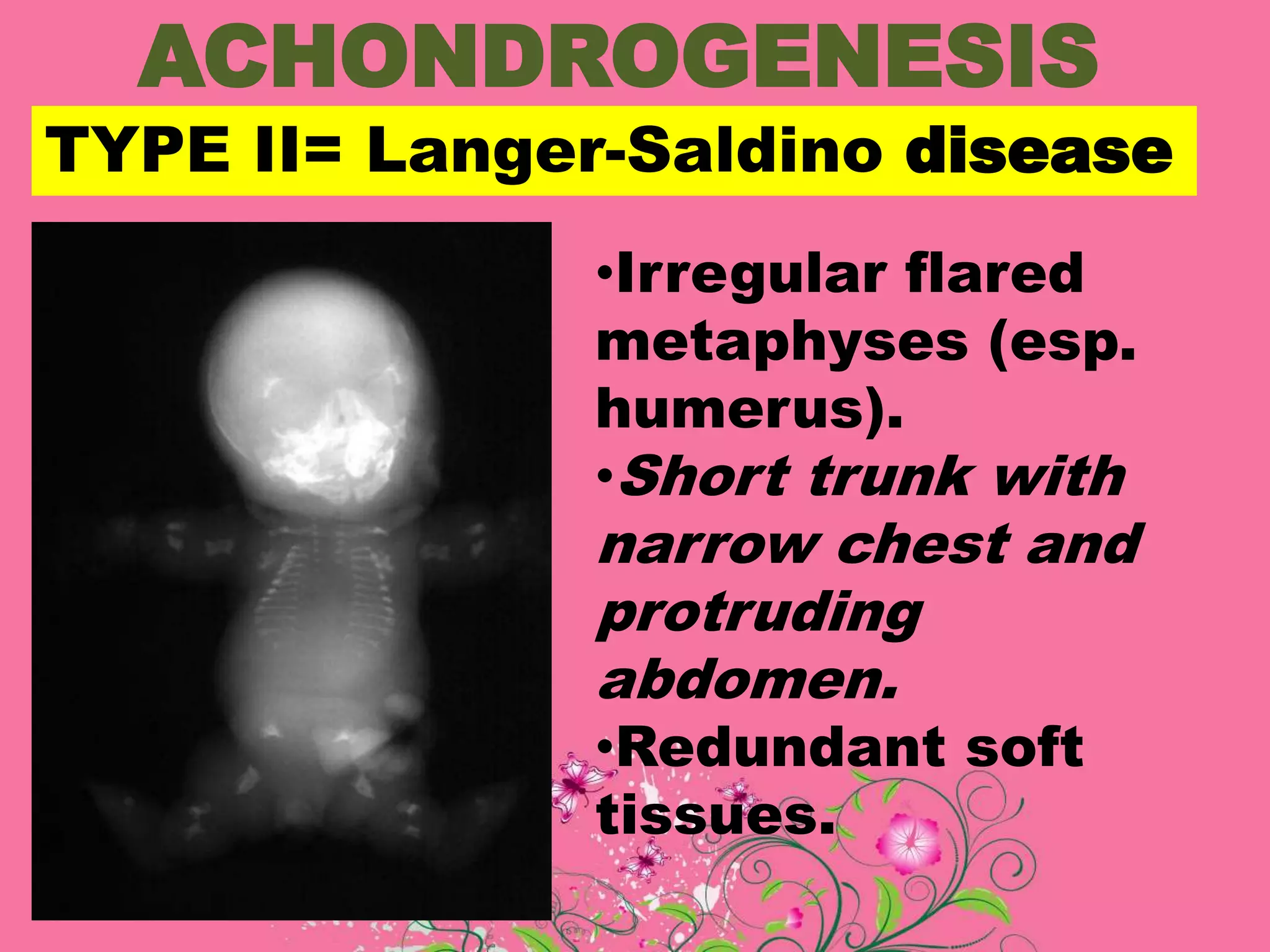 Achondrogenesis | PPTX