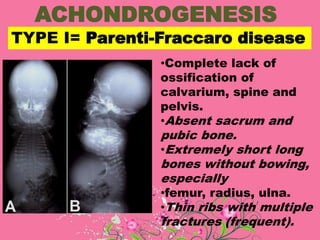 Achondrogenesis | PPTX | Death, Injury, or Military Conflict ...