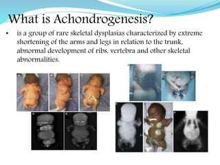 Achondrogenesis type 1a. pptx | PPTX