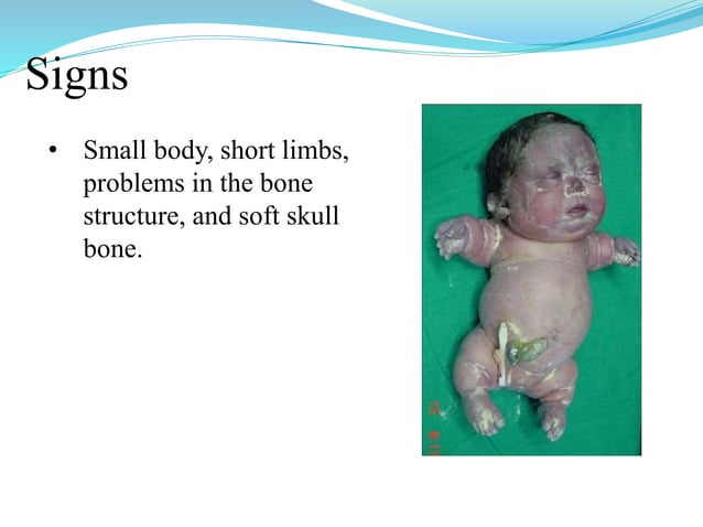 Achondrogenesis type 1a. pptx | PPTX | Bone and Joint Conditions ...