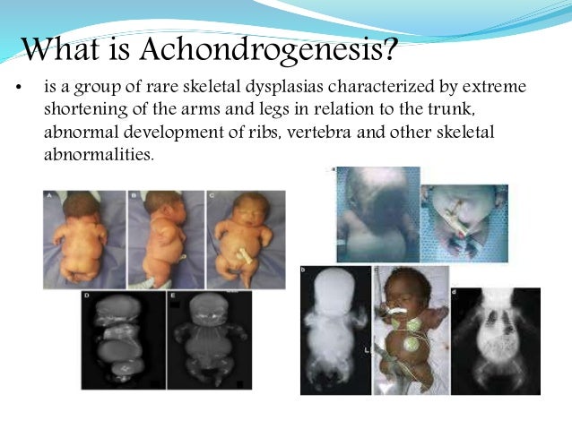 Achondrogenesis type 1a. pptx