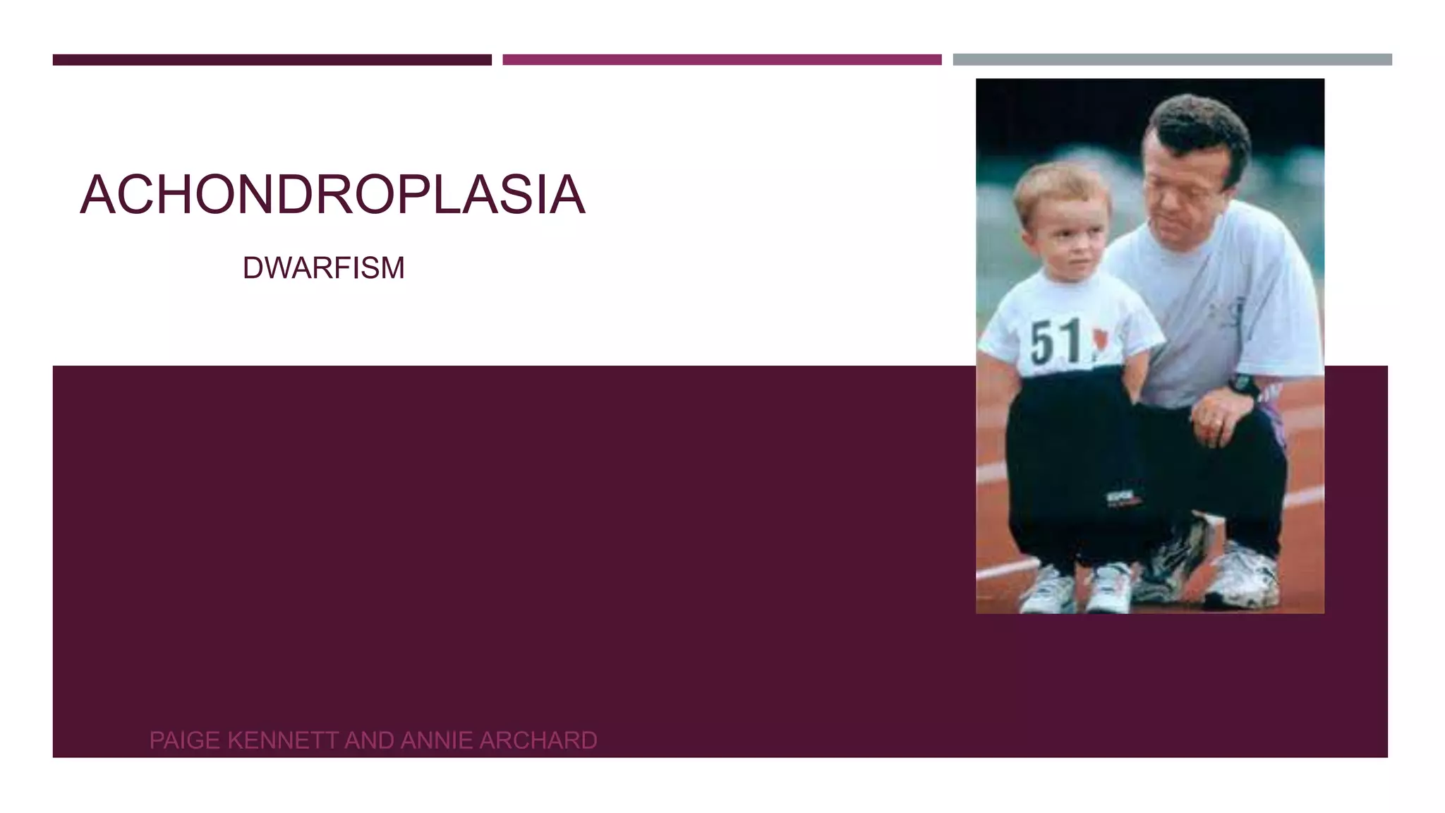Achondroplasia | PPTX