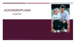Achondroplasia | PPTX