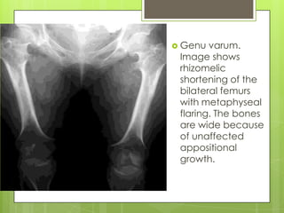Rhizomelia Xray