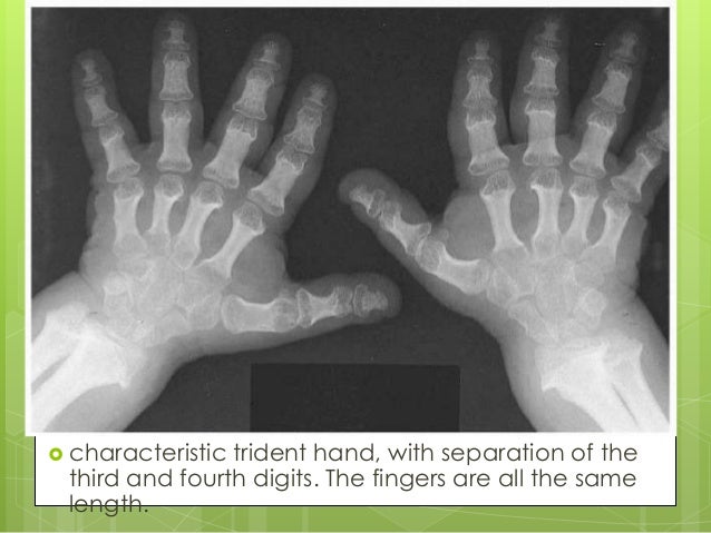 Decoding The Language of The Hand: How to find 38 conditions with 56 ...