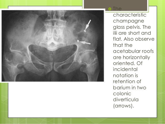 Achondroplasia, pseudoachondroplasia, hypochondroplasia