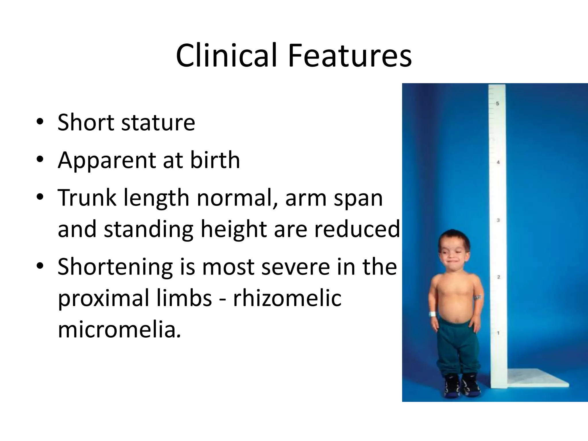 Achondroplasia, Hypochondroplasia and Spondyloepiphyseal Dysplasia | PPTX