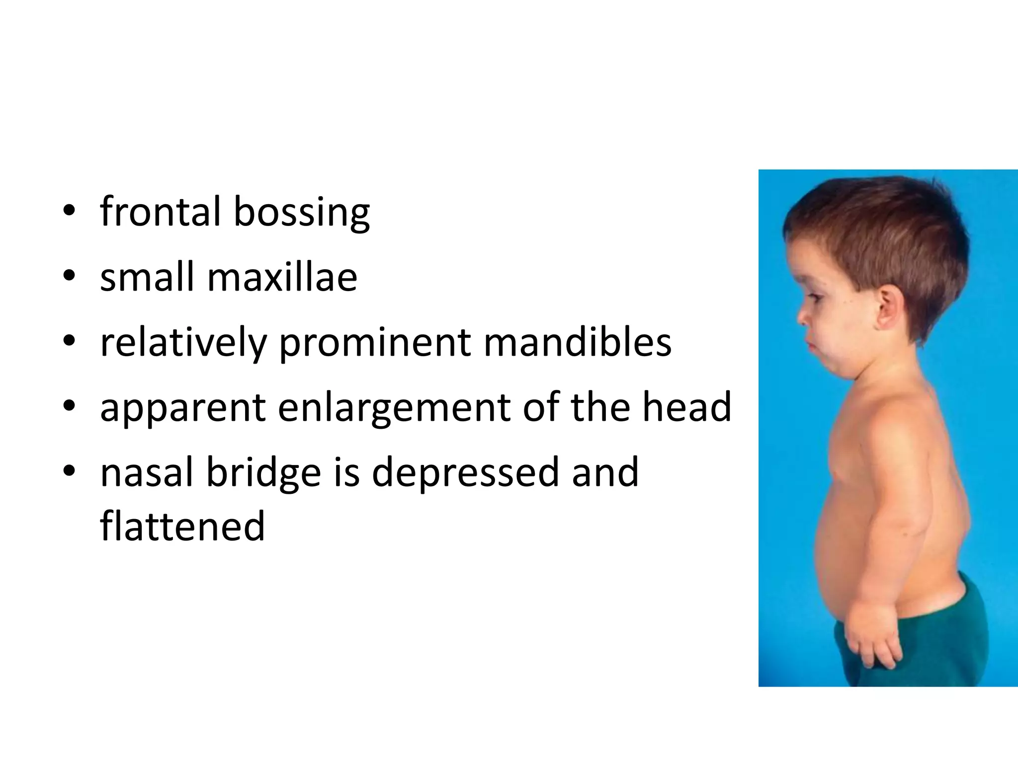 Achondroplasia, Hypochondroplasia and Spondyloepiphyseal Dysplasia | PPTX