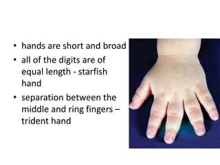 Achondroplasia, Hypochondroplasia and Spondyloepiphyseal Dysplasia | PPTX