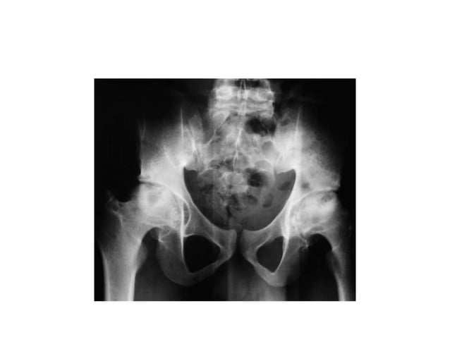 Achondroplasia Hypochondroplasia And Spondyloepiphyseal Dysplasia