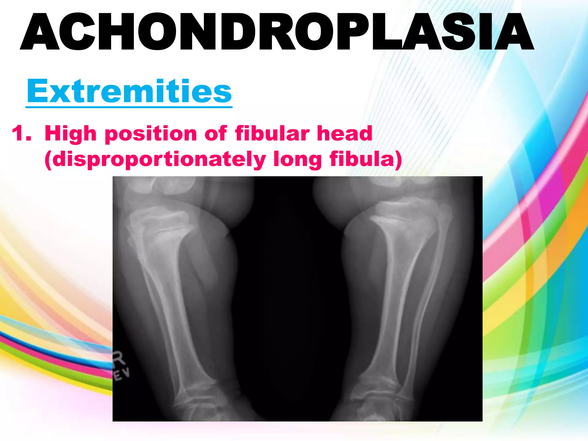 Achondroplasia | PPTX
