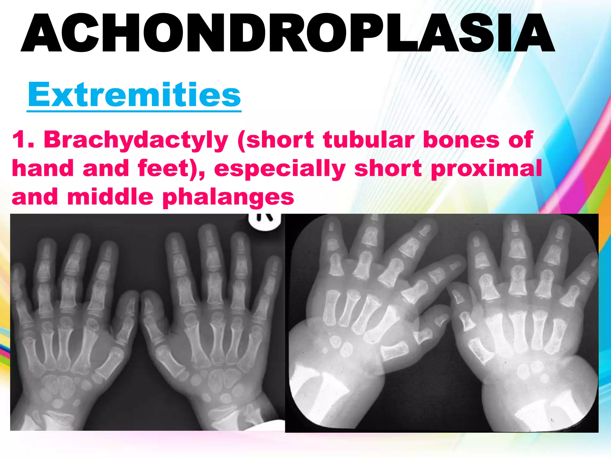 Achondroplasia | PPTX