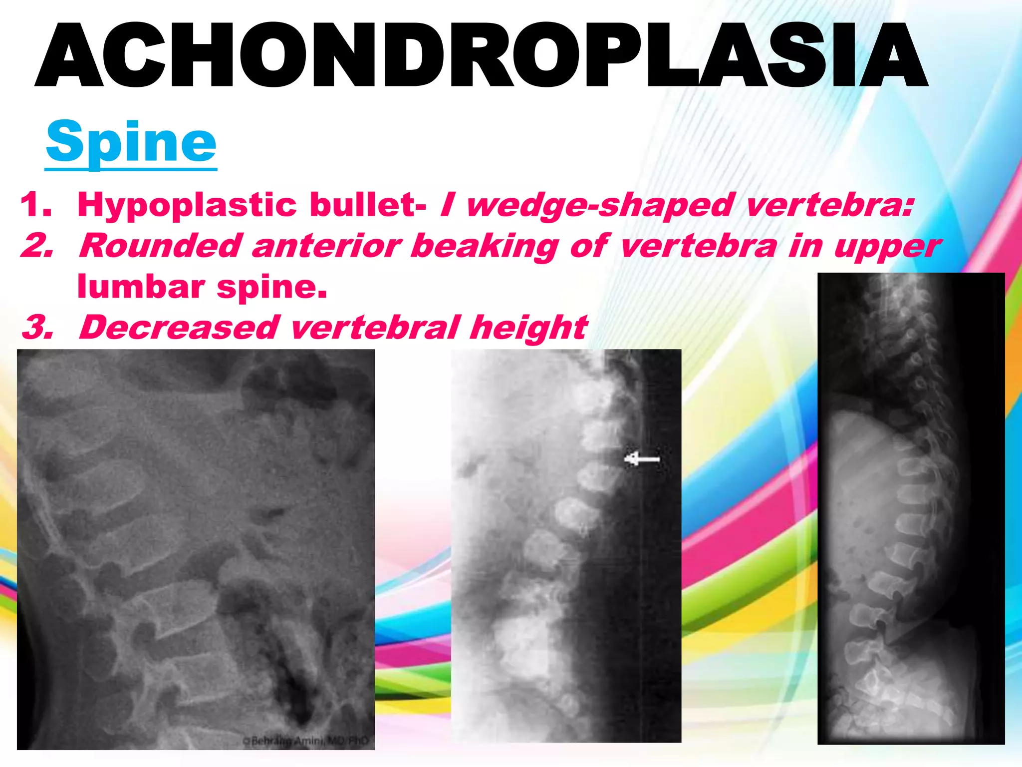 Achondroplasia | PPTX