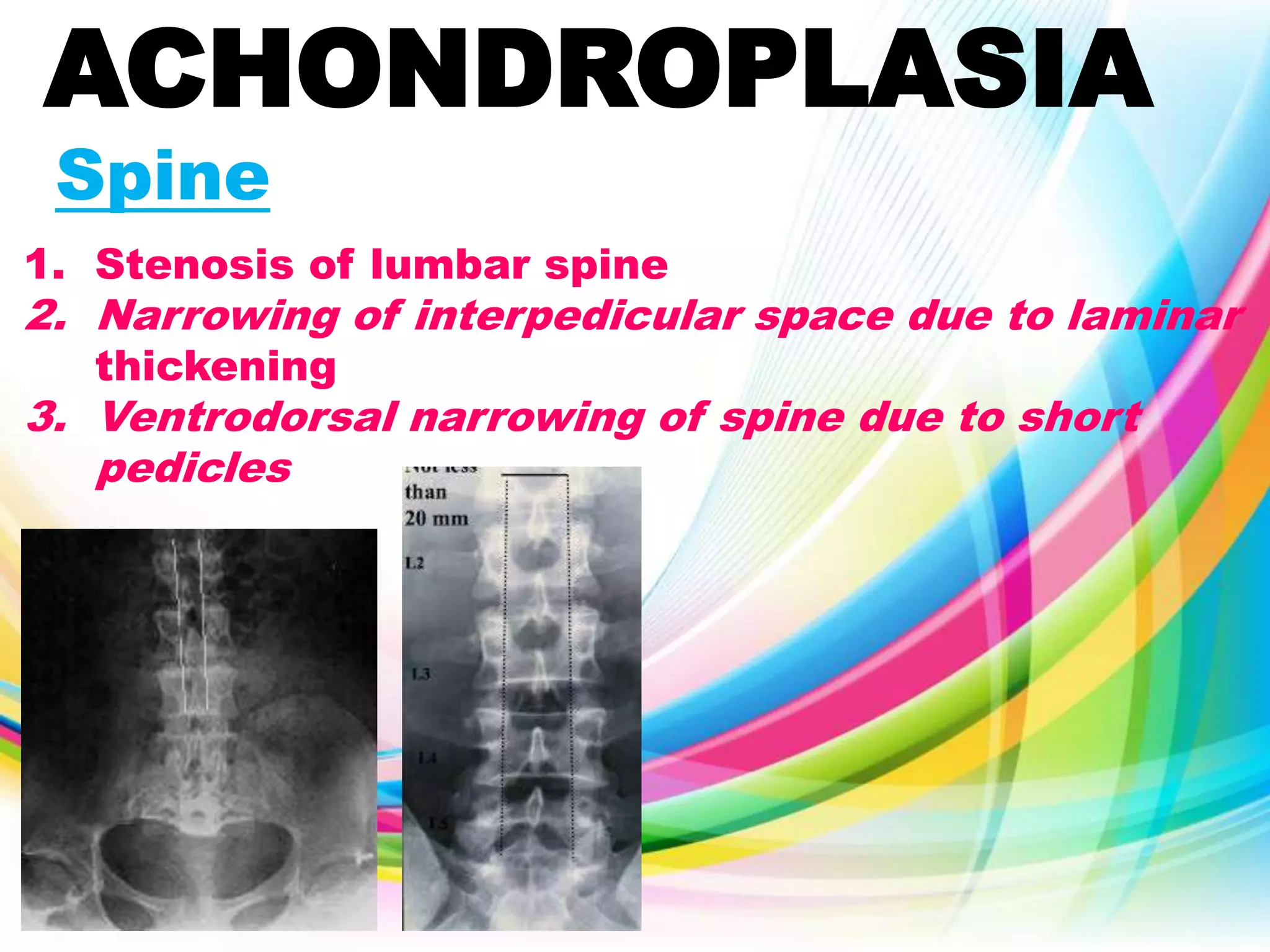 Achondroplasia | PPTX