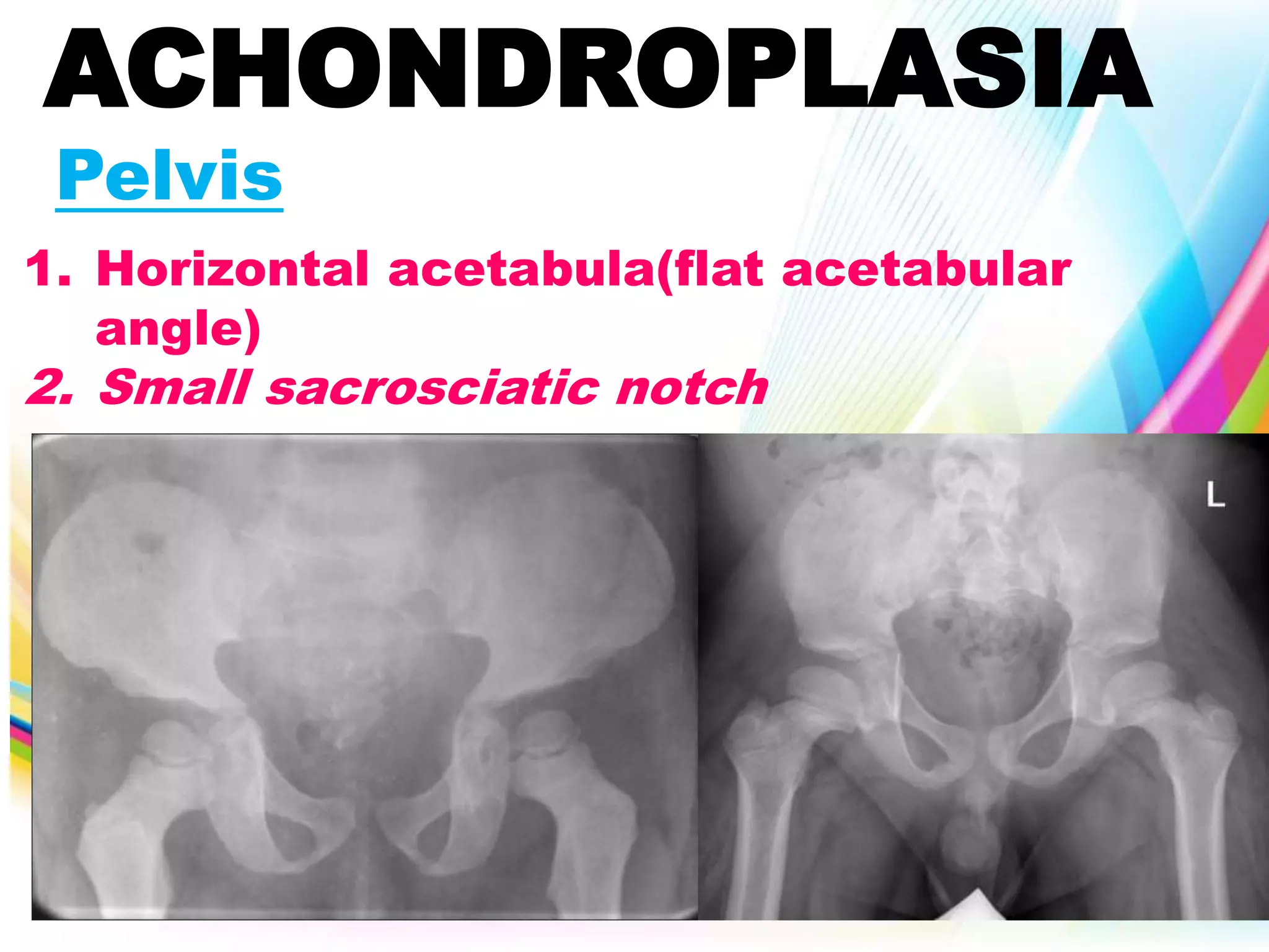 Achondroplasia | PPTX