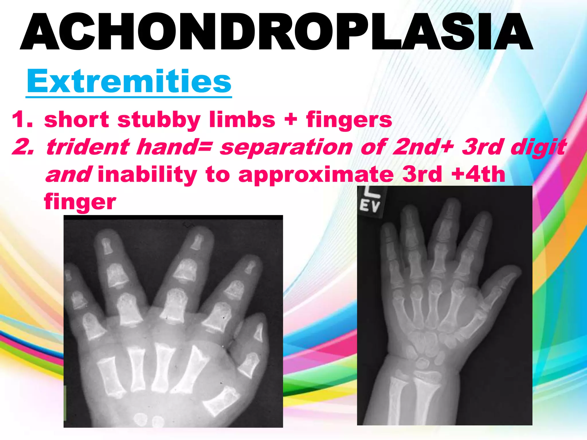 Achondroplasia | PPTX