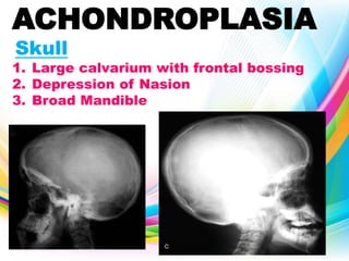 Achondroplasia | PPTX