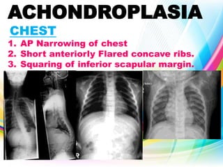 Achondroplasia | PPTX