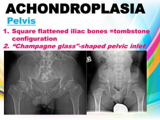 Achondroplasia | PPTX