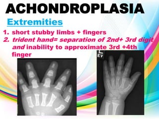 Achondroplasia | PPT