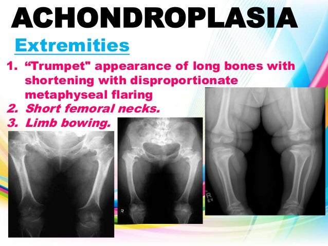 Achondroplasia