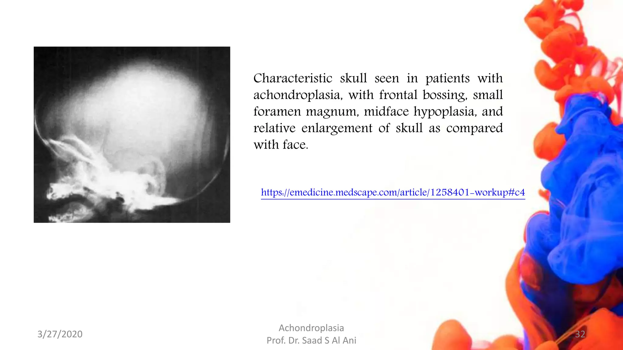Achondroplasia | PPTX