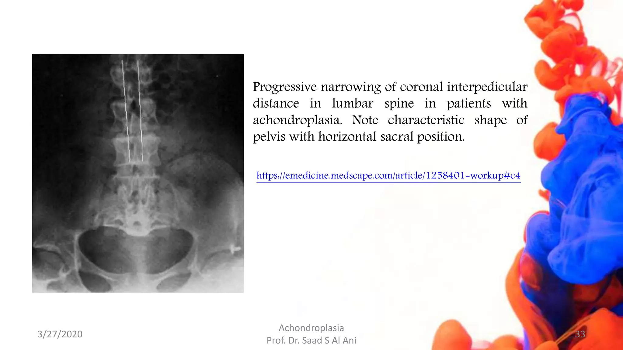 Achondroplasia | PPTX