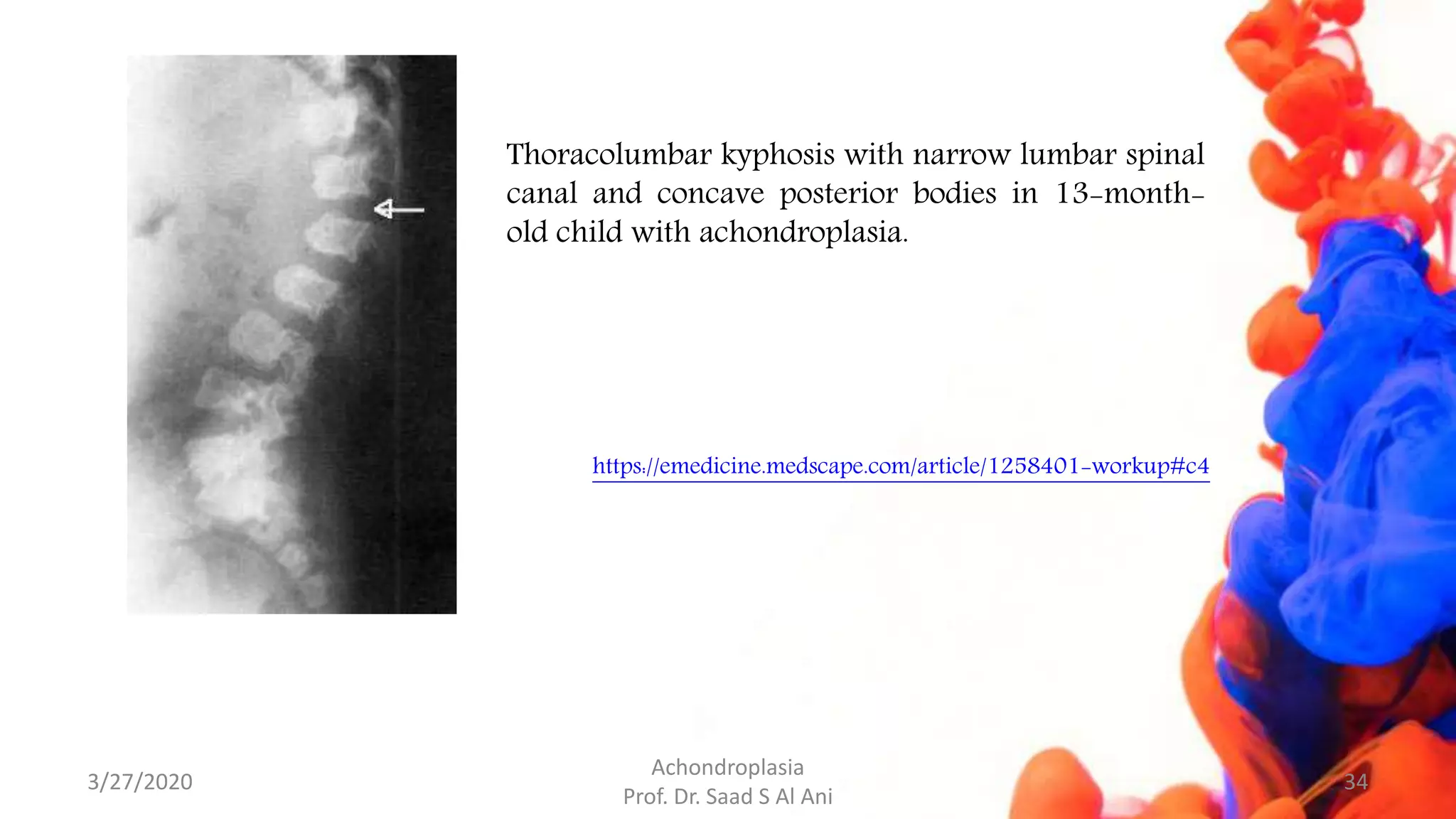 Achondroplasia | PPTX
