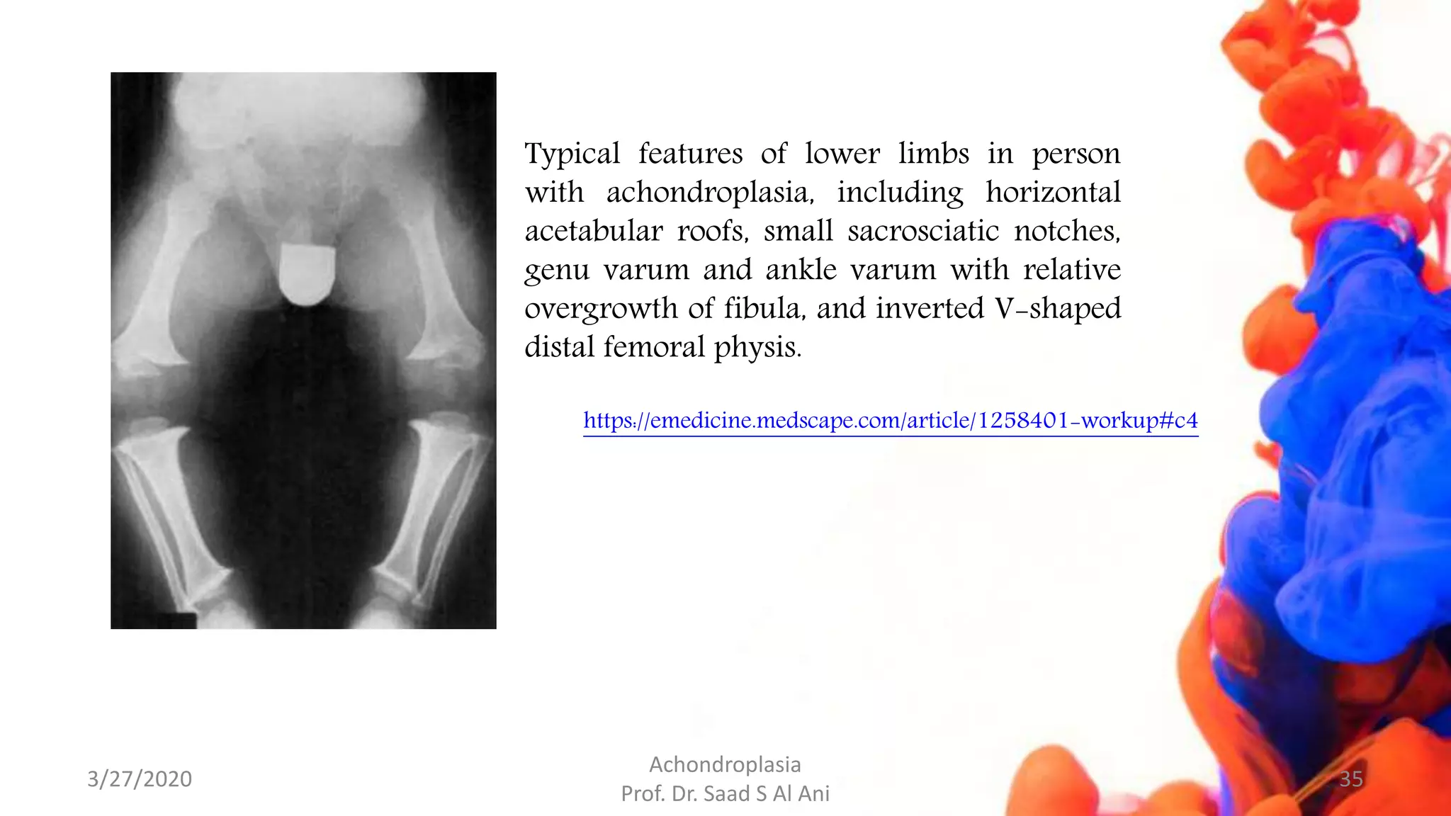 Achondroplasia | PPTX