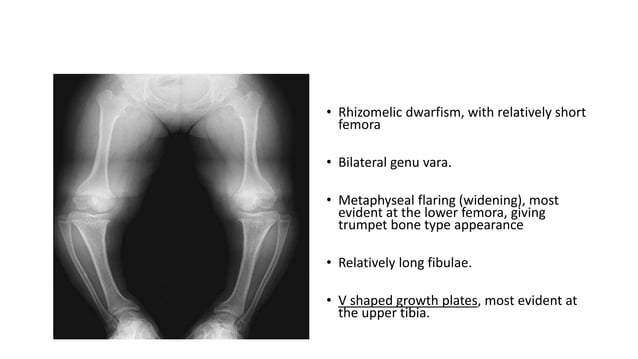 ACHONDROPLASIA.pptx