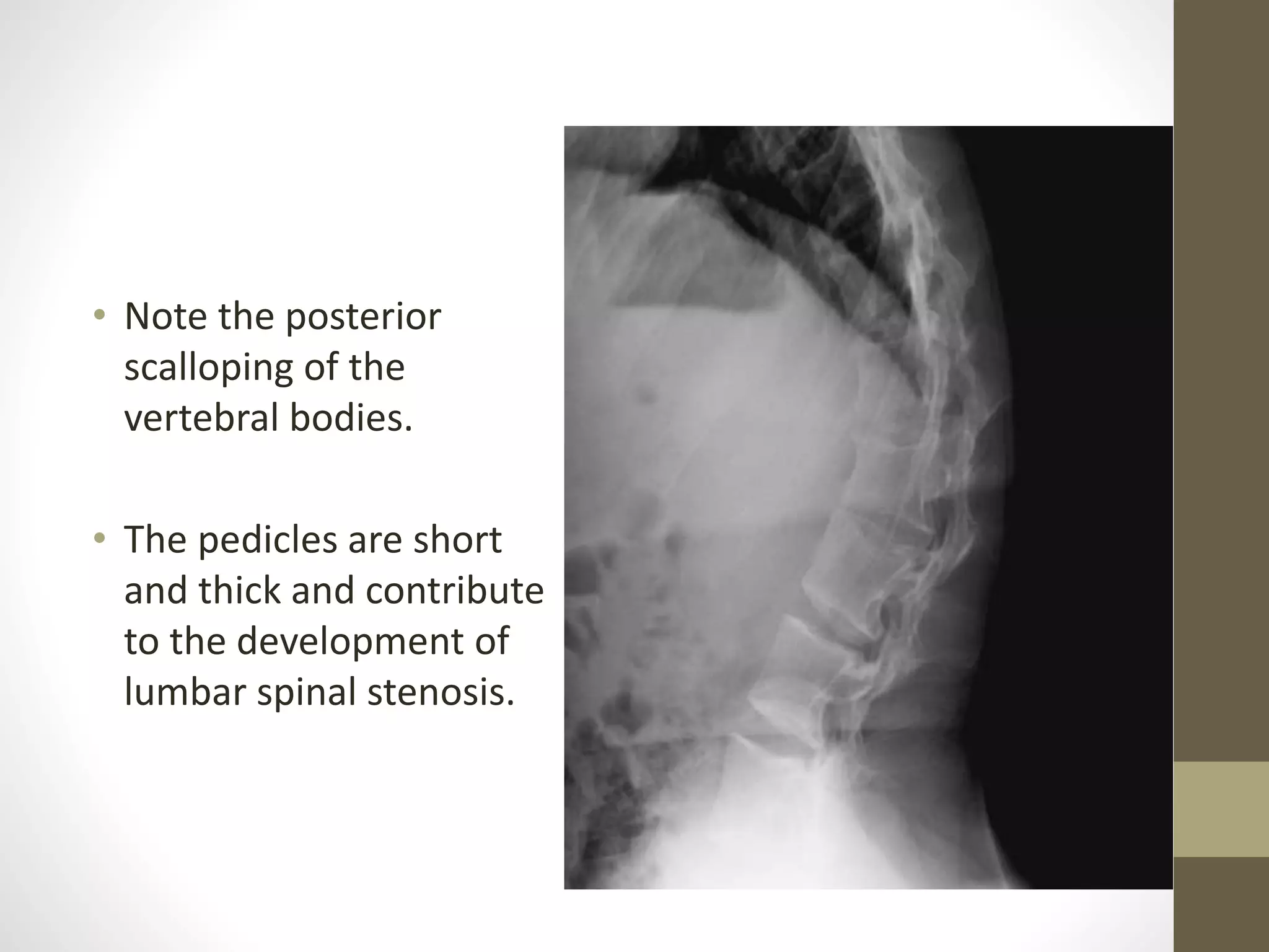 Achondroplasia, pseudochondroplasia & hypochondroplasia | PPTX