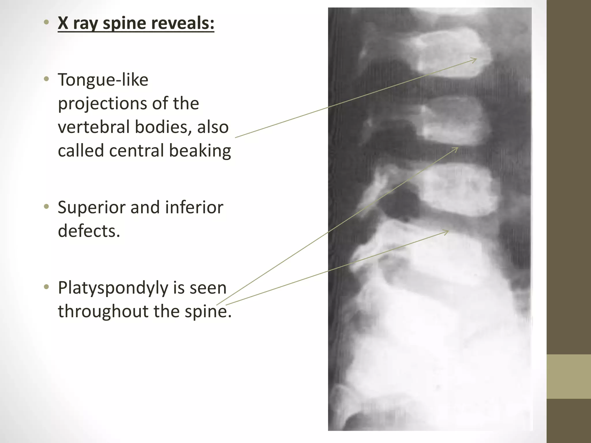Achondroplasia, pseudochondroplasia & hypochondroplasia | PPTX
