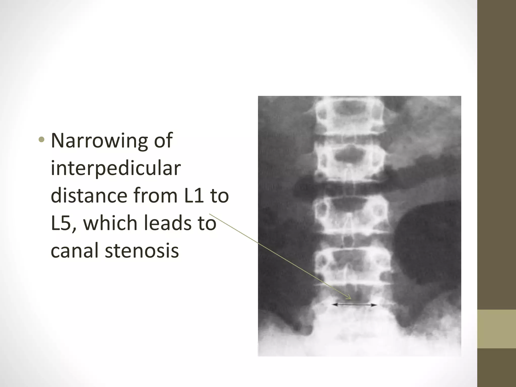 Achondroplasia, pseudochondroplasia & hypochondroplasia | PPTX